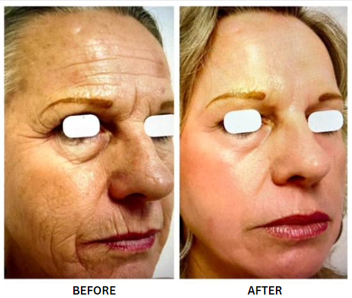 CO2 Laser Resurfacing in Wheeling, WV | Rejuvenation Center