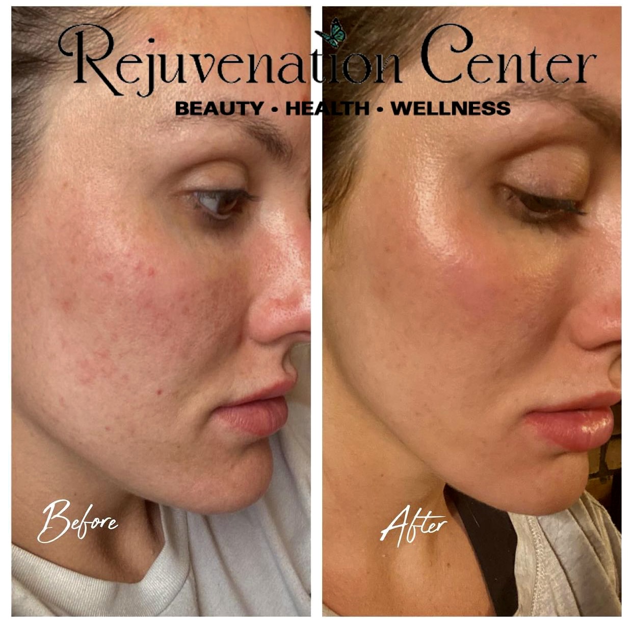 Vivace RF Treatments in Wheeling, WA | Rejuvenation Center